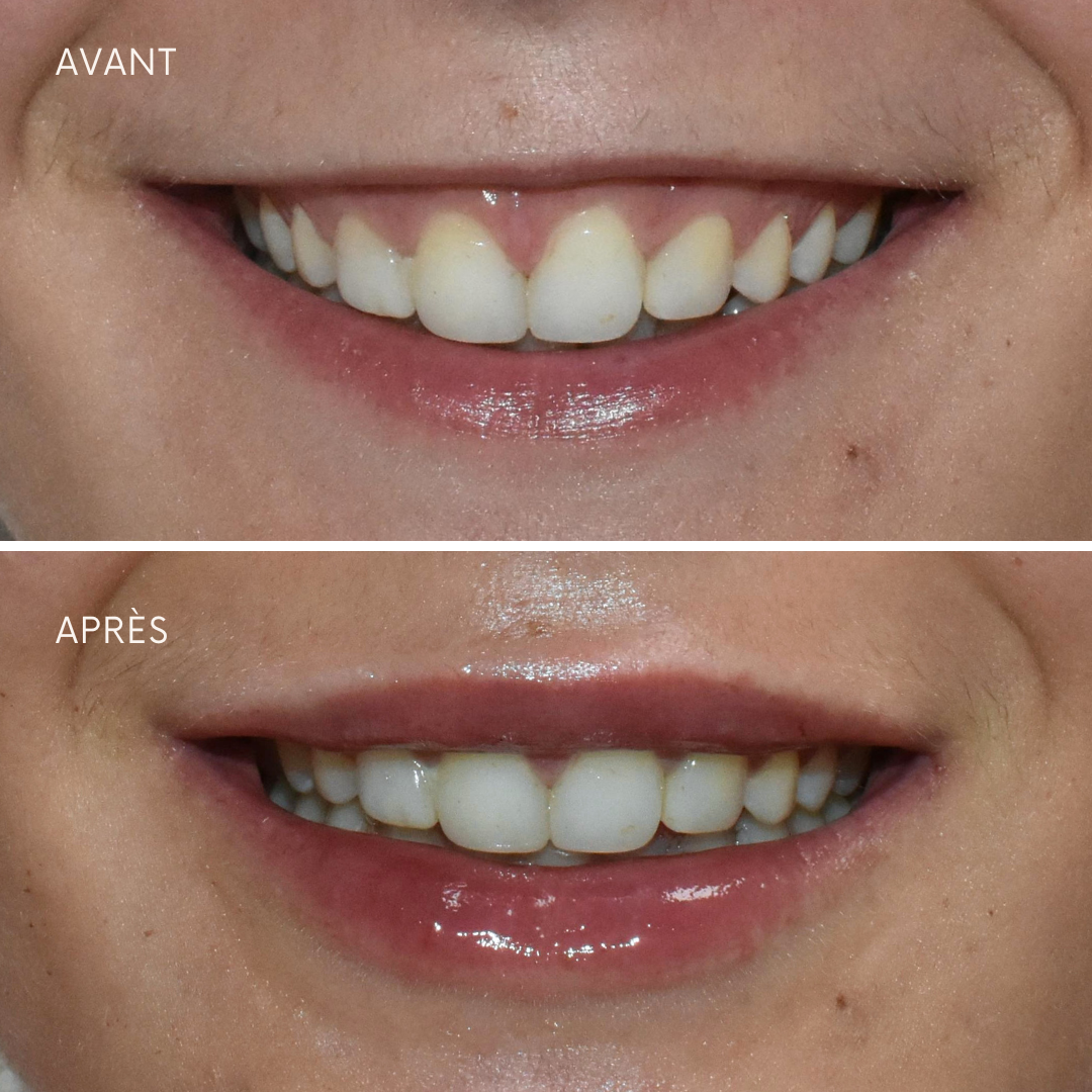 Envie de retrouver le sourire ? - Forever Institut