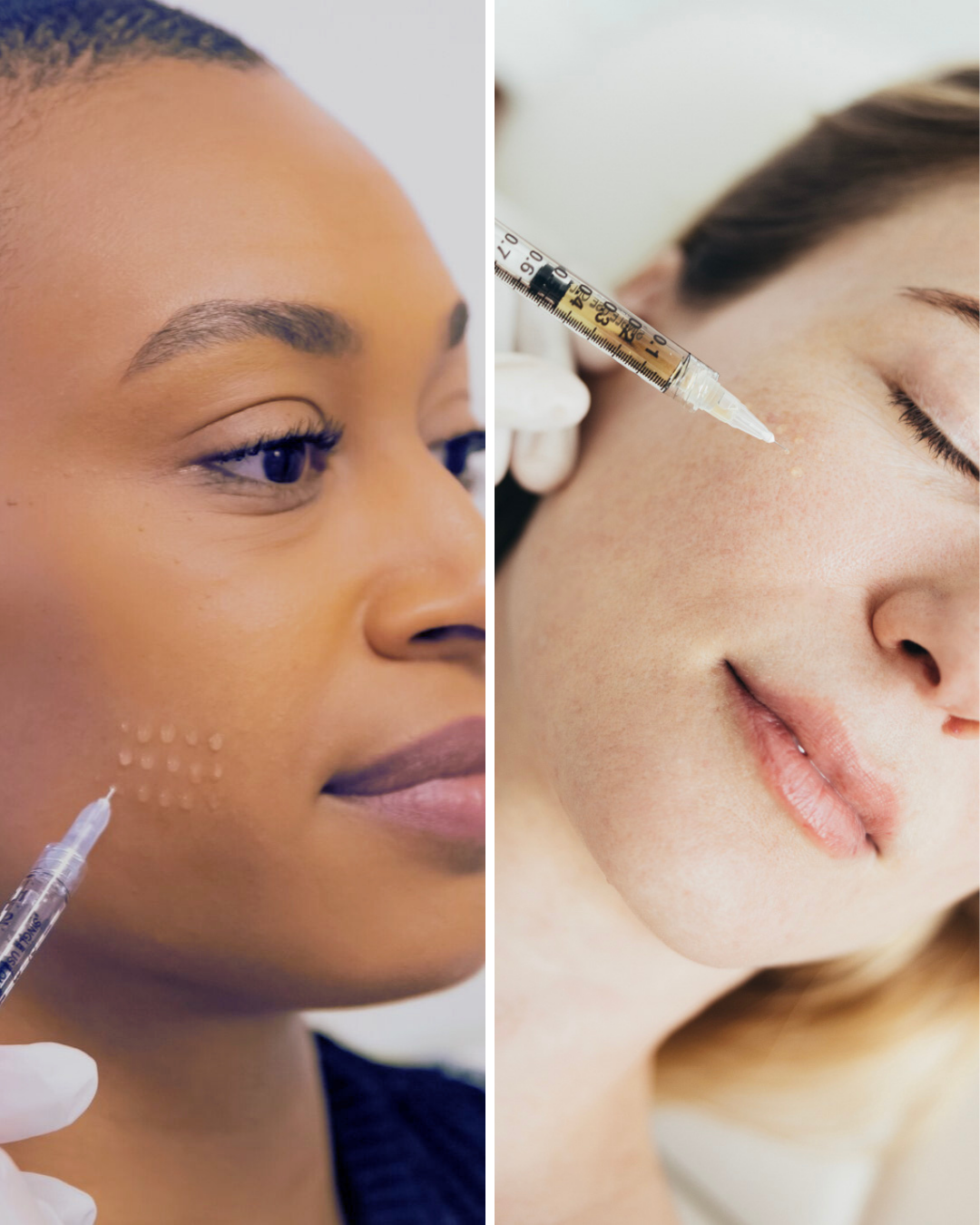PRP + Mesotherapy for the face - Forever Institut